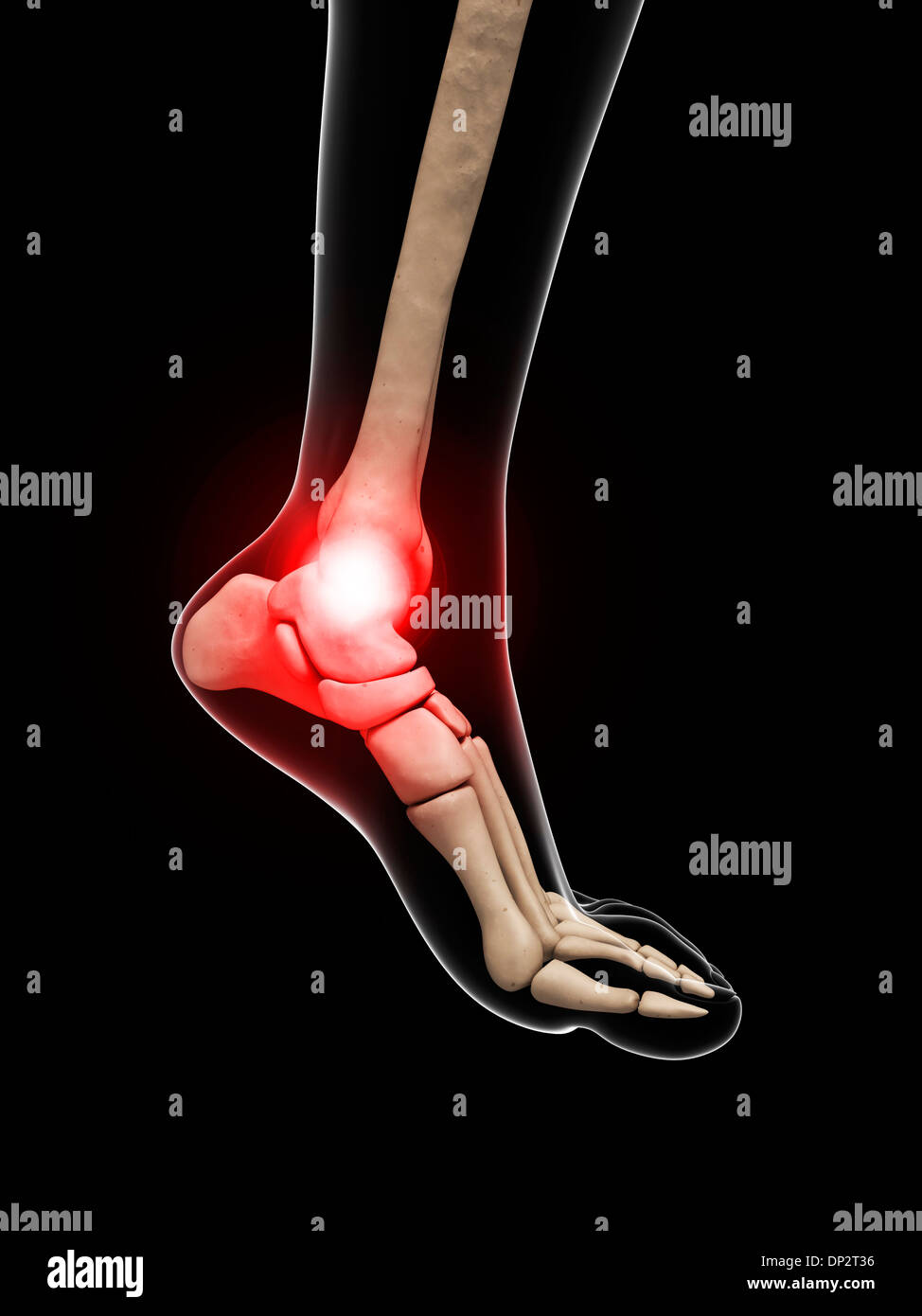 Painful ankle, artwork Stock Photo - Alamy
