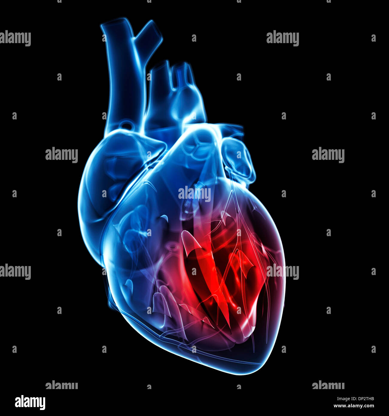 Heart attack, artwork Stock Photo - Alamy