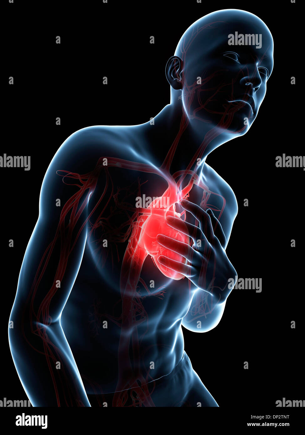 Heart attack, artwork Stock Photo - Alamy
