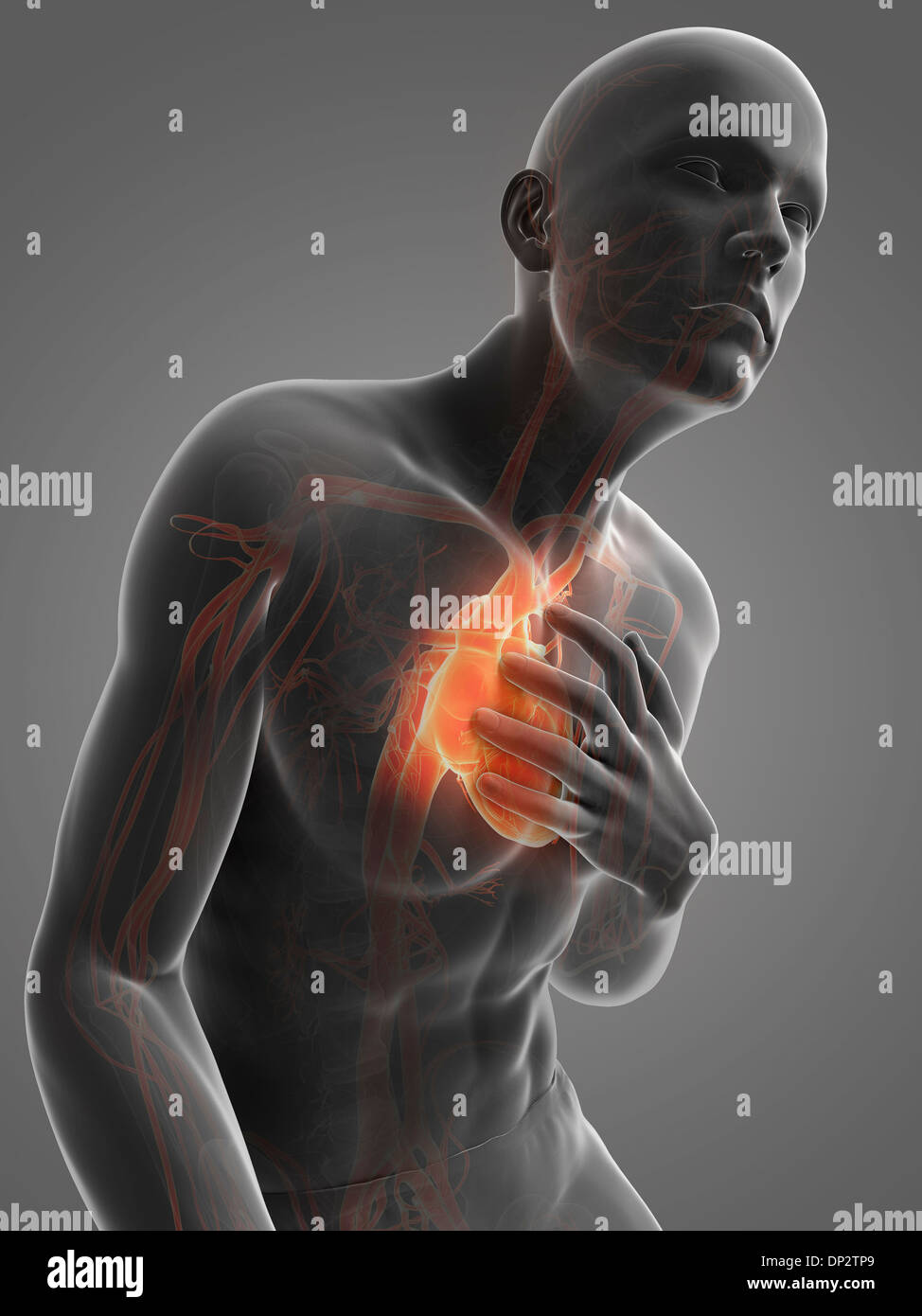 Heart attack, artwork Stock Photo - Alamy