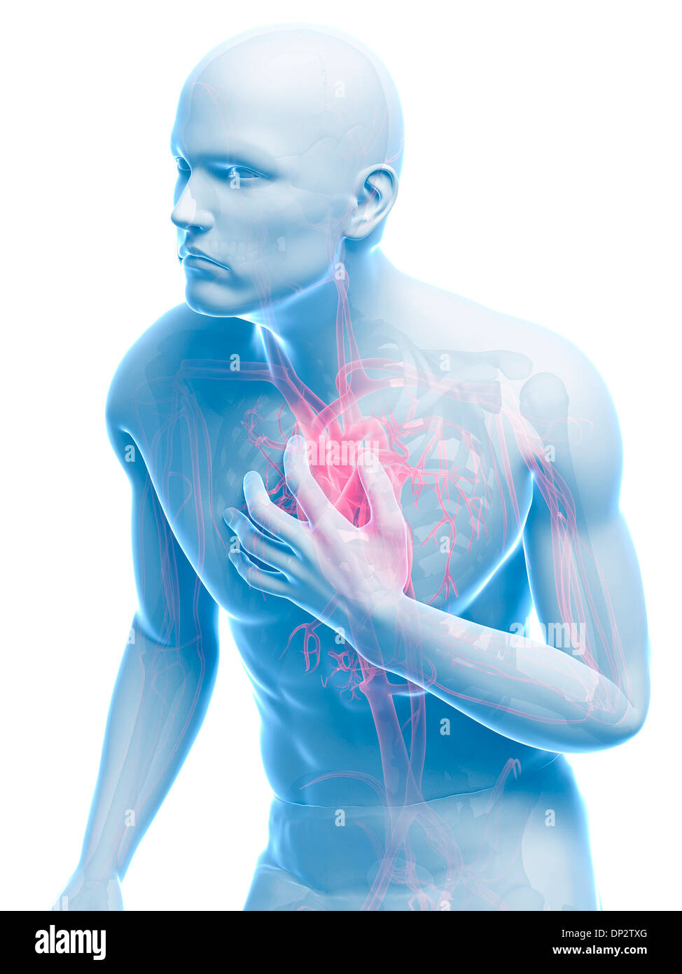 Heart attack, artwork Stock Photo - Alamy