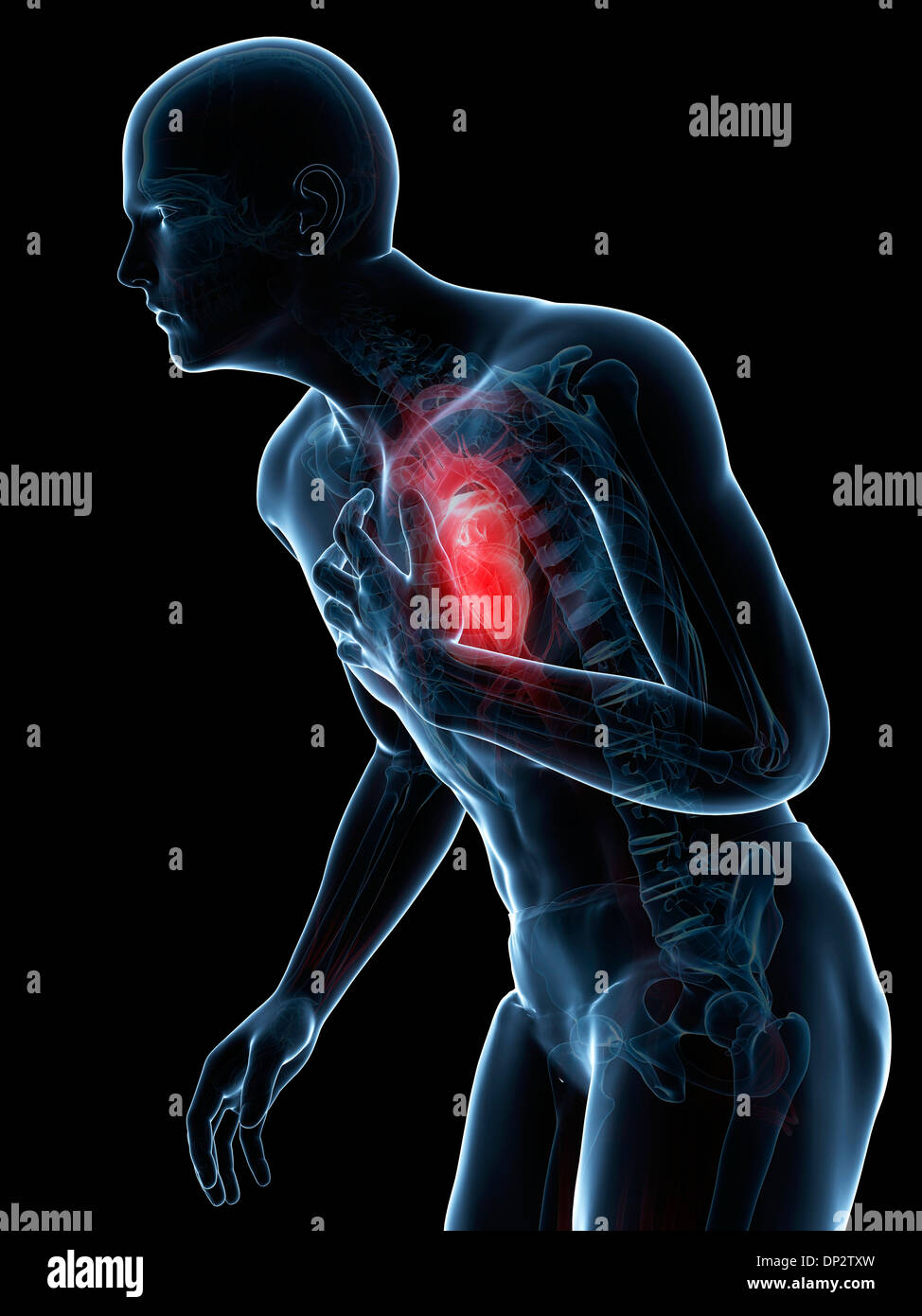 Heart attack, artwork Stock Photo - Alamy