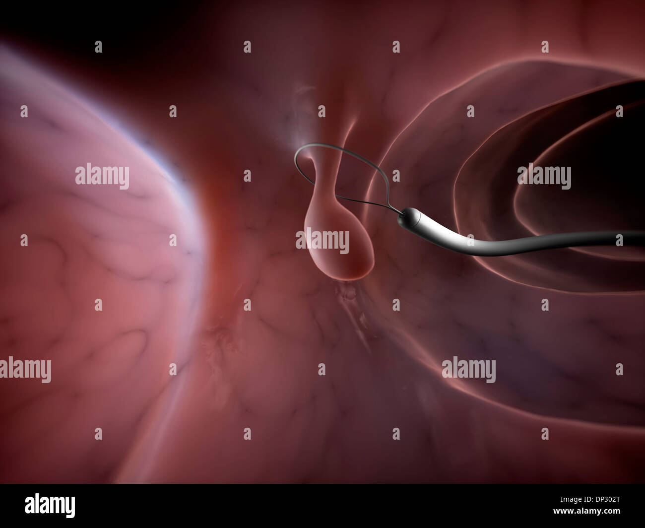 Colon polyp hi-res stock photography and images - Alamy