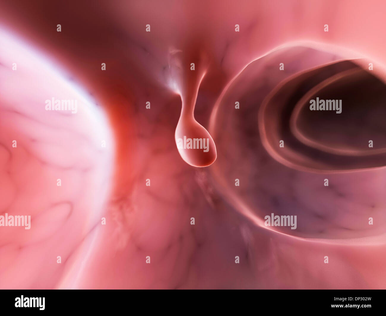 Colon polyp hi-res stock photography and images - Alamy