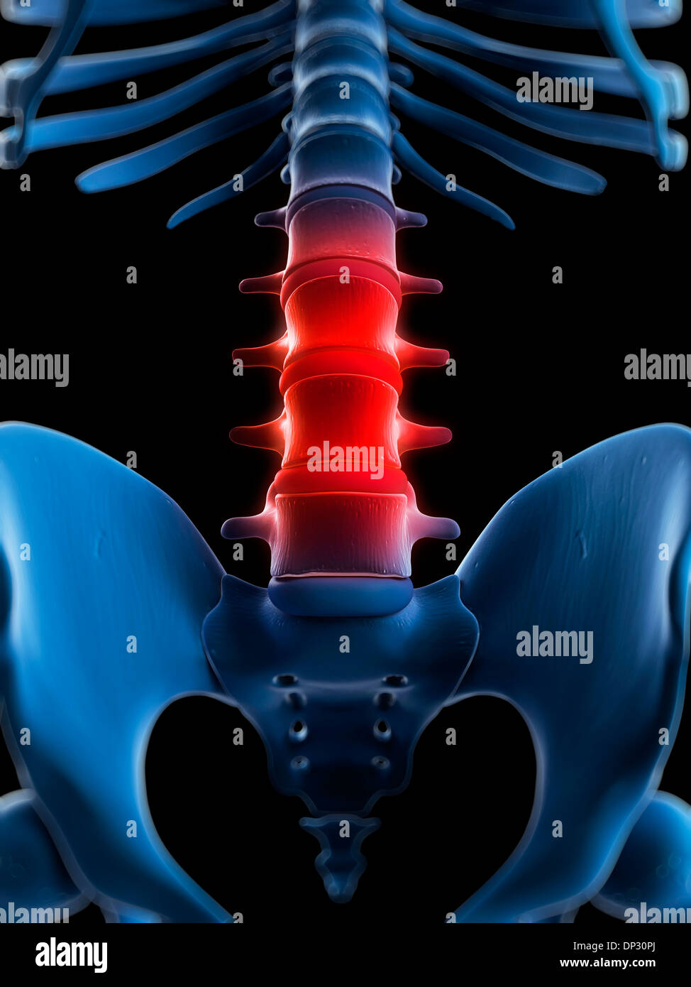 Painful lumbar spine, artwork Stock Photo - Alamy