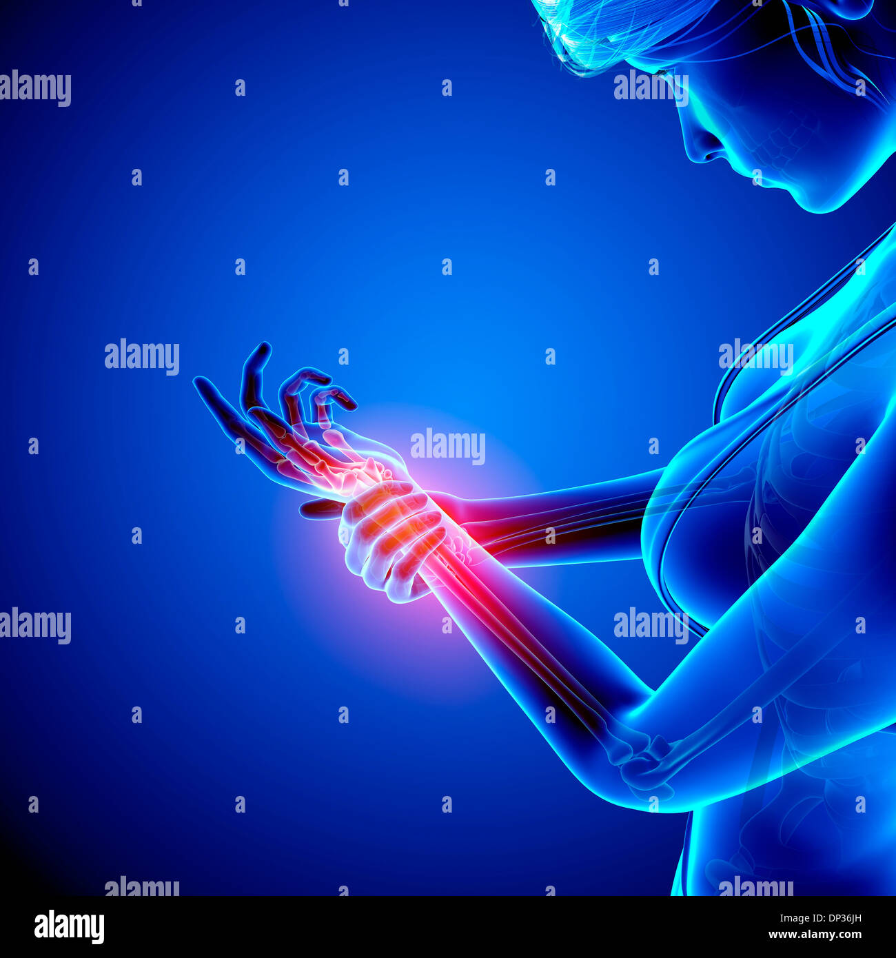 Wrist pain, artwork Stock Photo - Alamy Wrist pain, artwork Stock Photo - Alamy