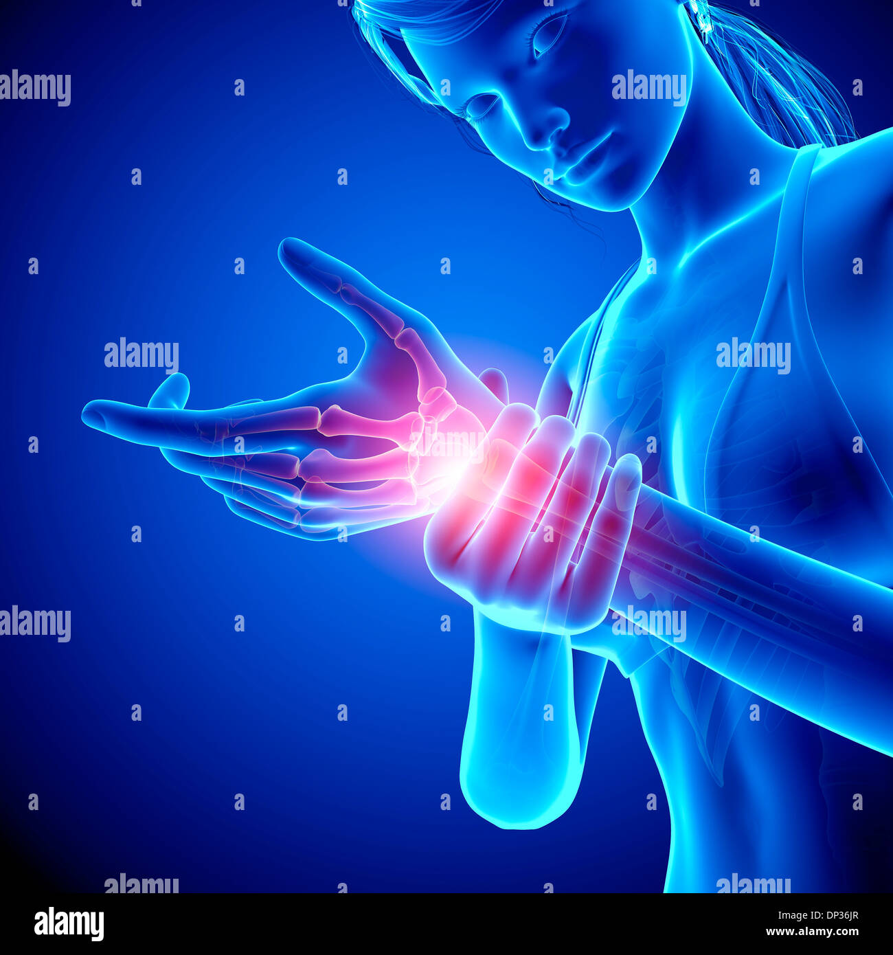Wrist pain, artwork Stock Photo - Alamy