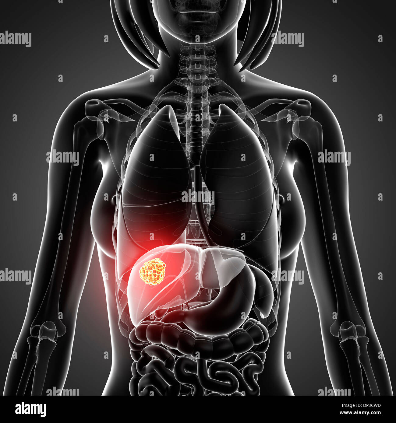 Liver cancer hi-res stock photography and images - Alamy