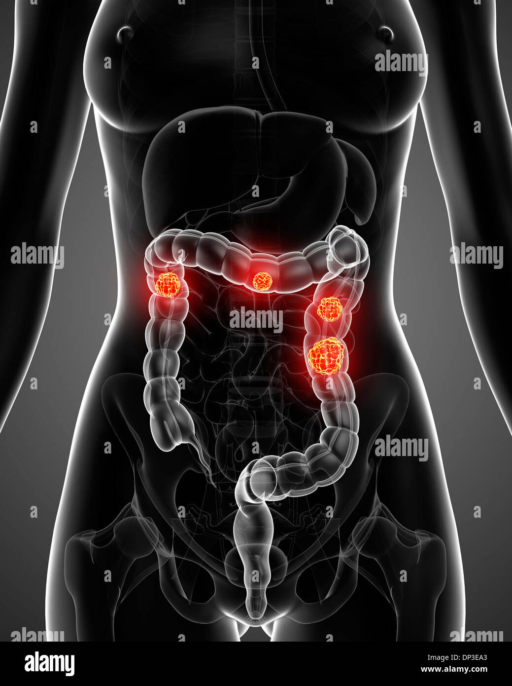 Abnormal colon hi-res stock photography and images - Alamy