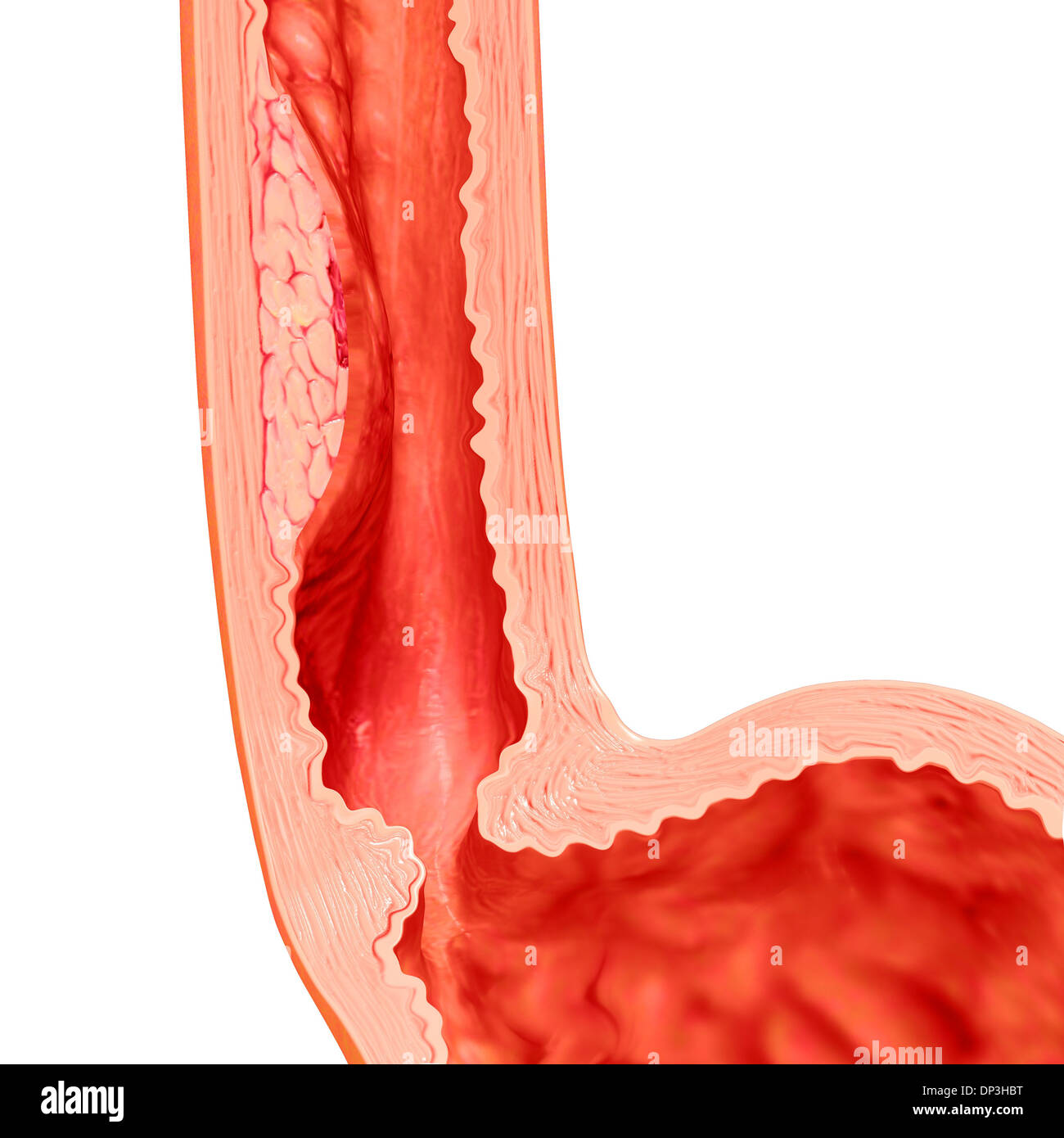 Barrett oesophagus symptoms, artwork Stock Photo - Alamy