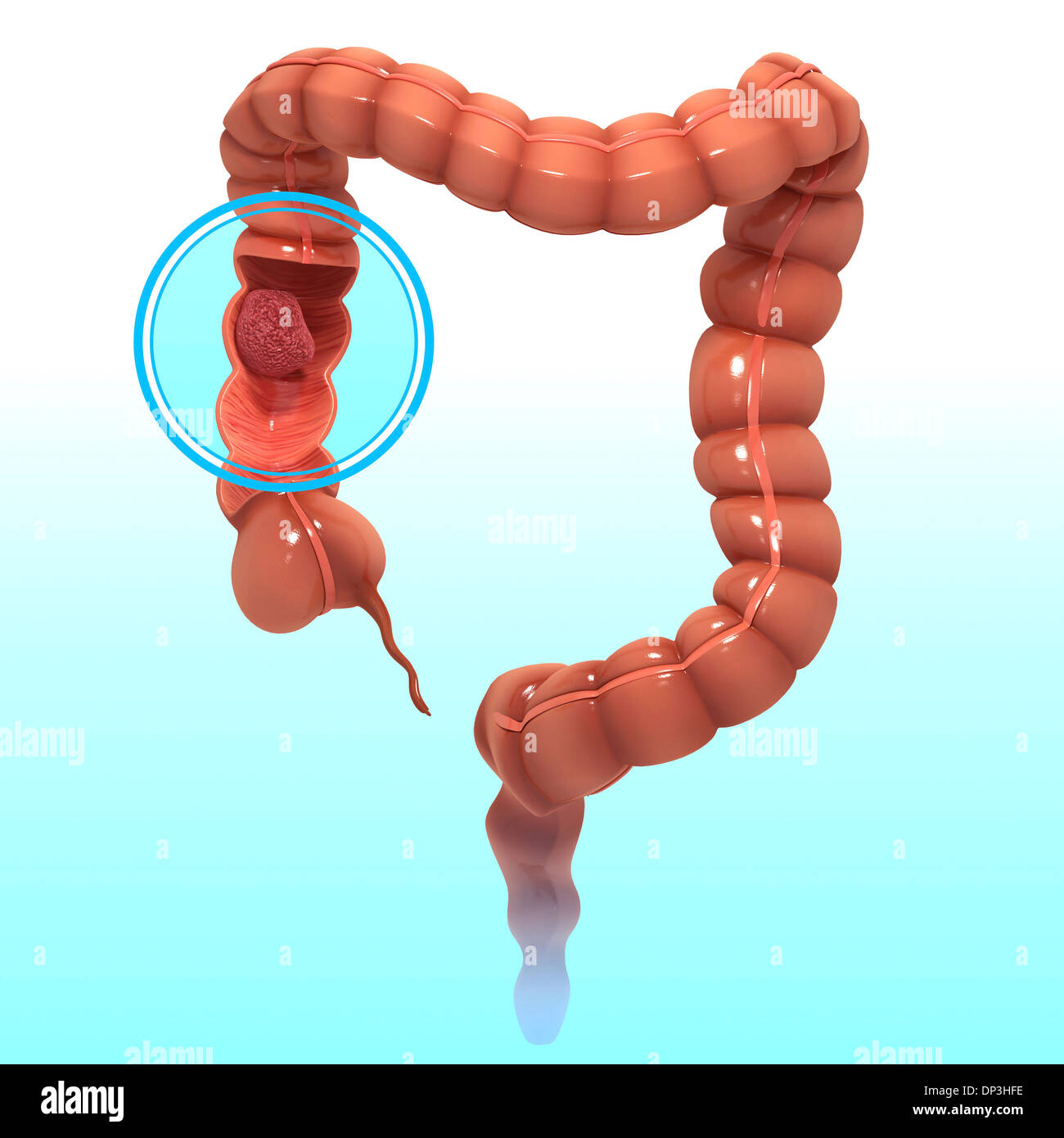 Colon cancer, artwork Stock Photo - Alamy