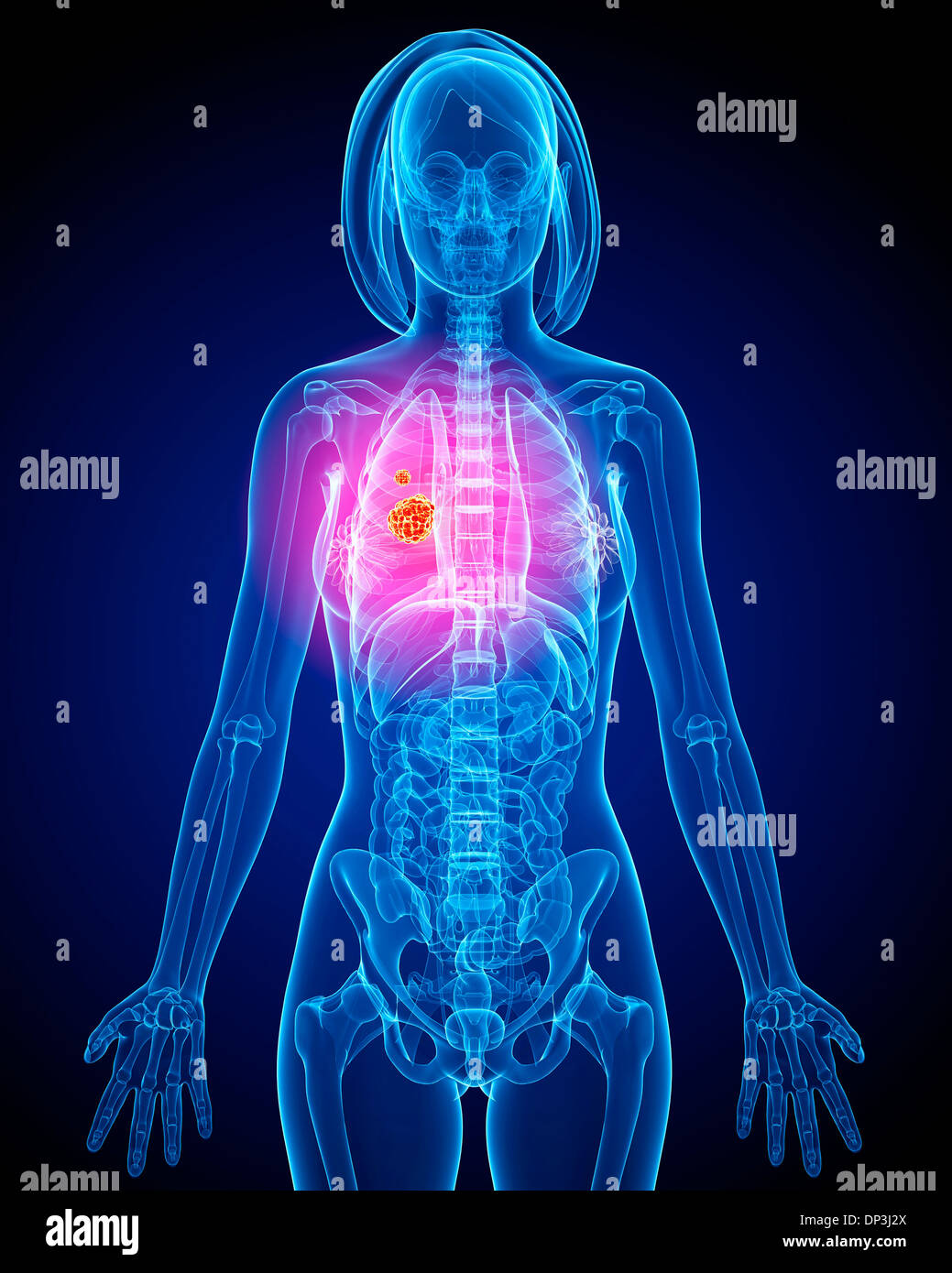 Lung cancer, artwork Stock Photo - Alamy