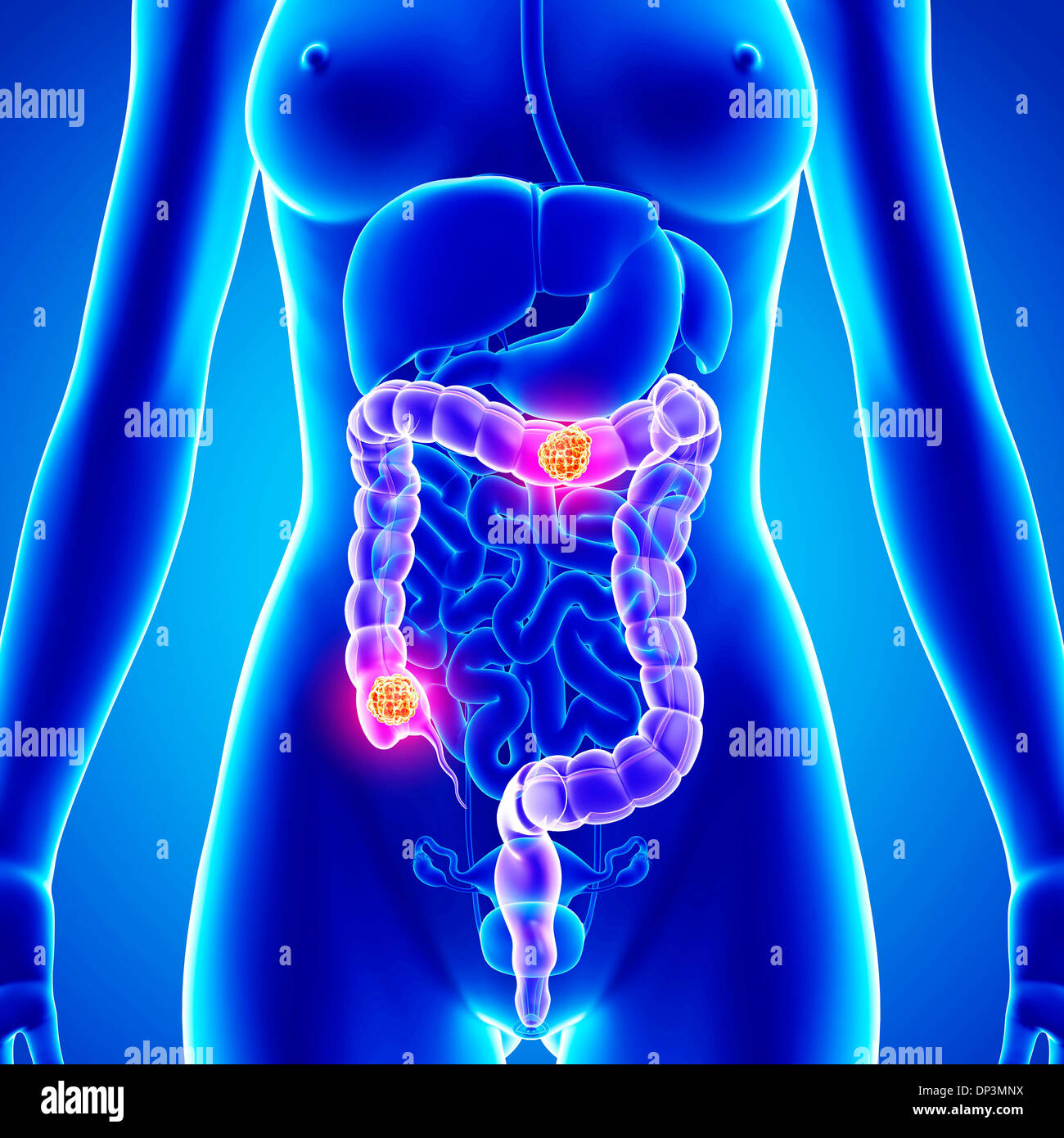 Colon cancer, artwork Stock Photo - Alamy