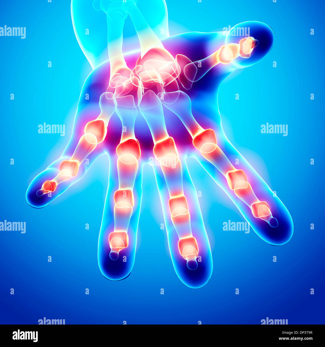 Hand pain, artwork Stock Photo - Alamy