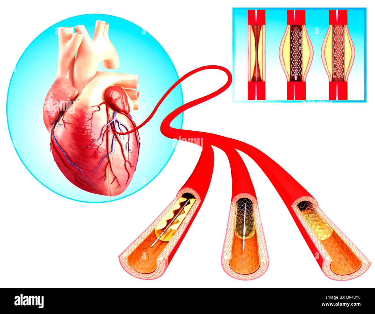 Coronary Angioplasty Stock Photos & Coronary Angioplasty Stock Images ...