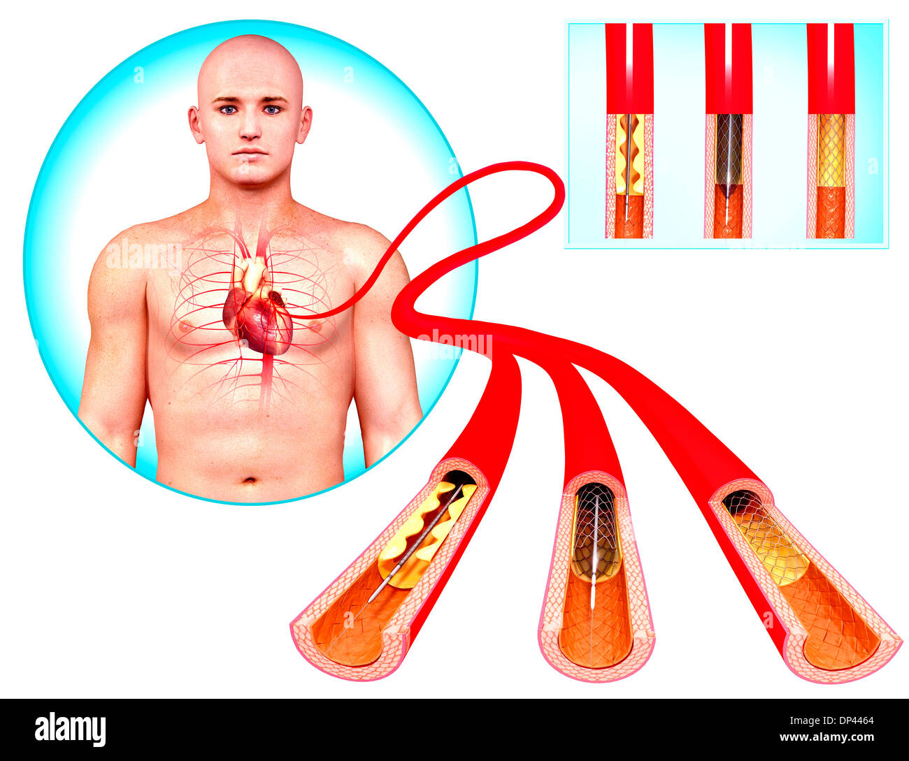 Coronary stent system hi-res stock photography and images - Alamy