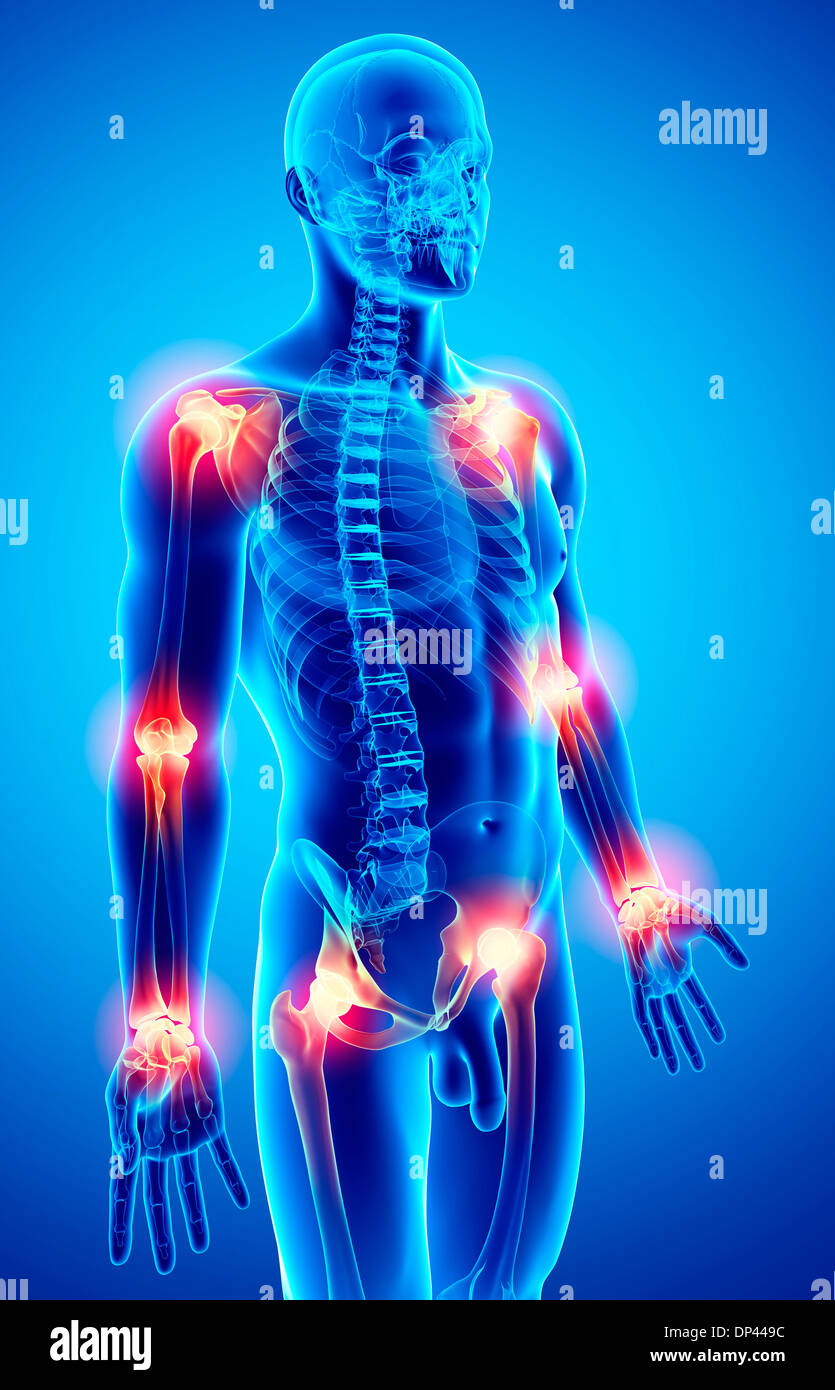 Joint pain, artwork Stock Photo - Alamy