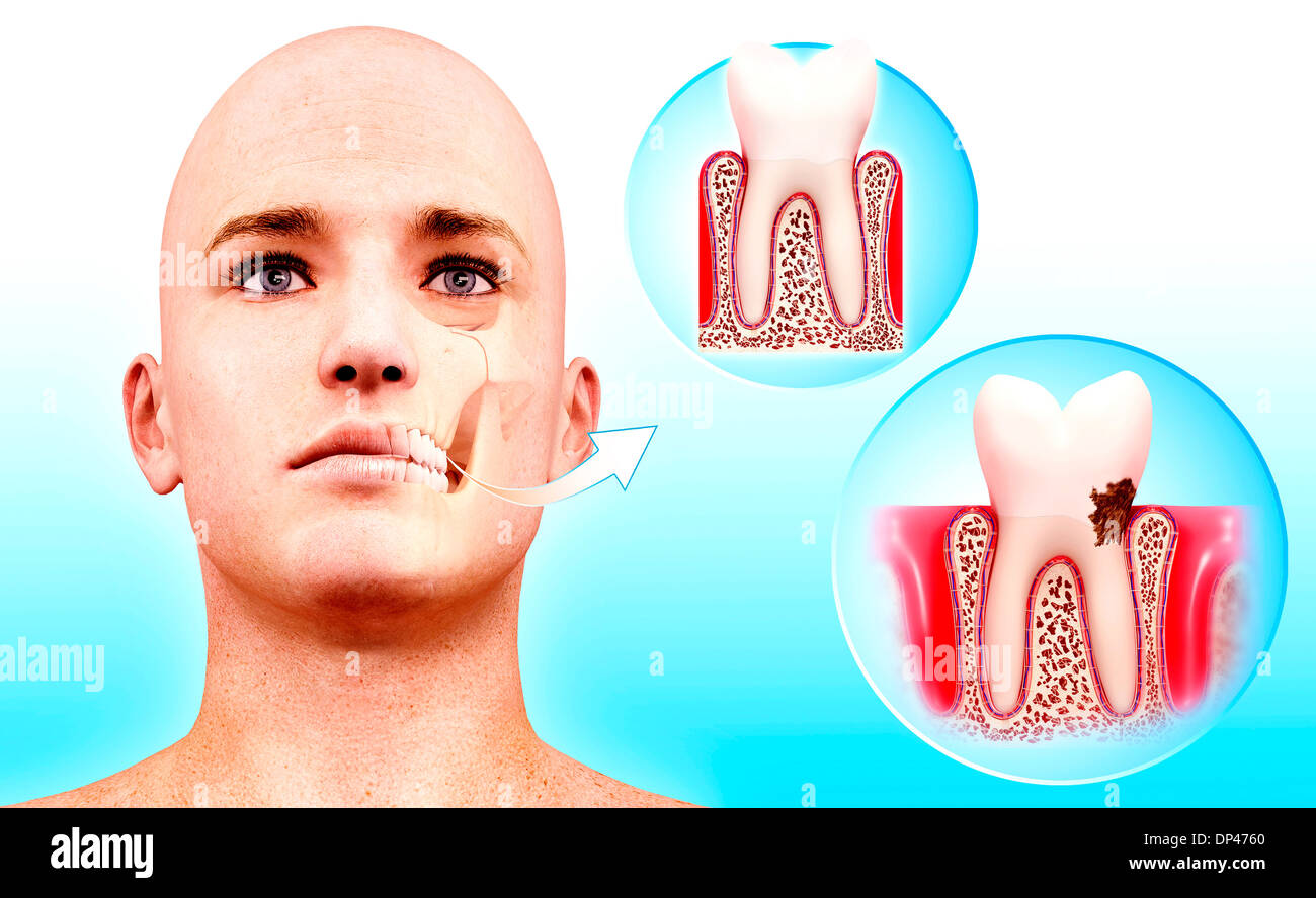 Molar tooth decay hi-res stock photography and images - Alamy