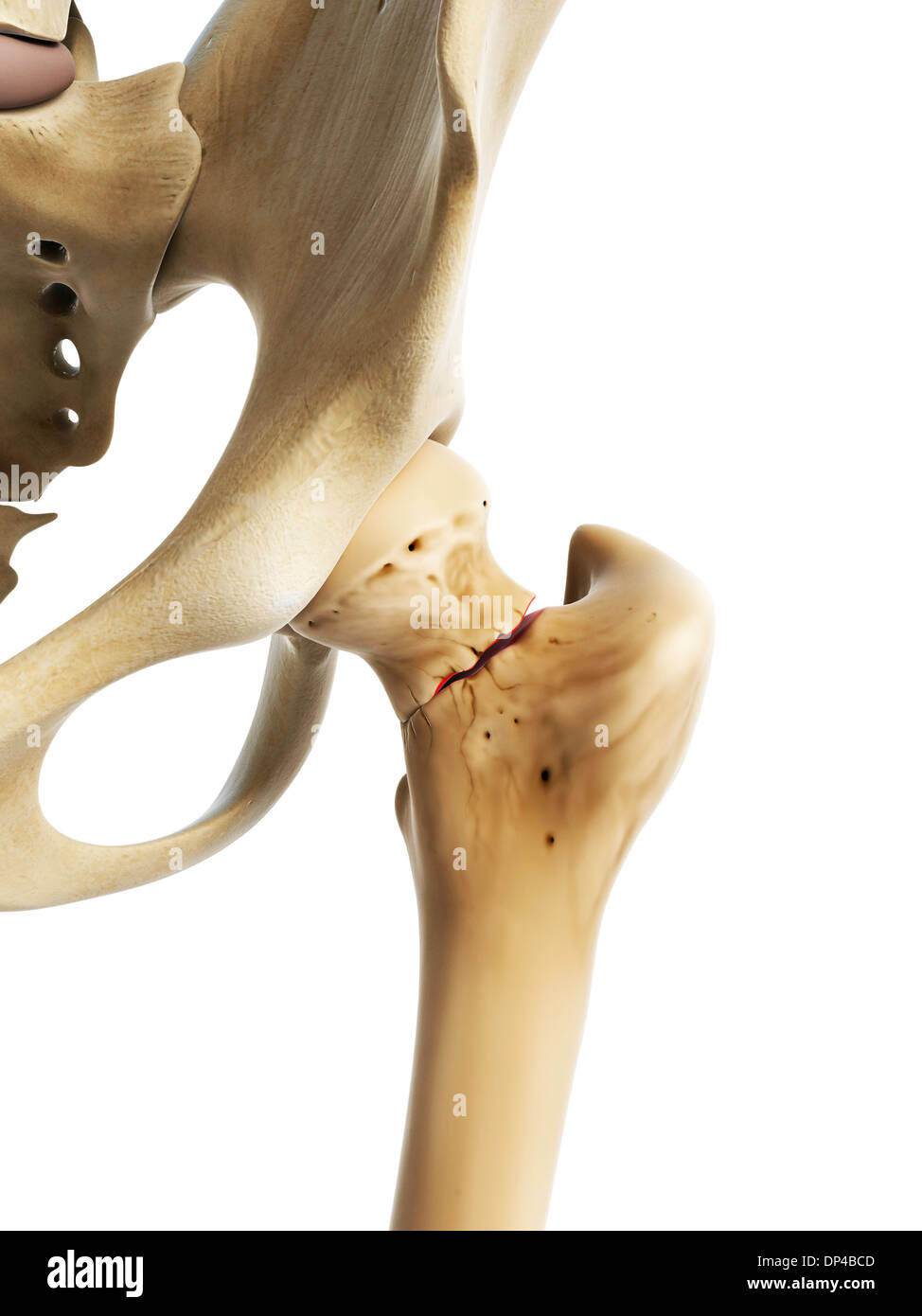 Hip fracture hi-res stock photography and images - Alamy