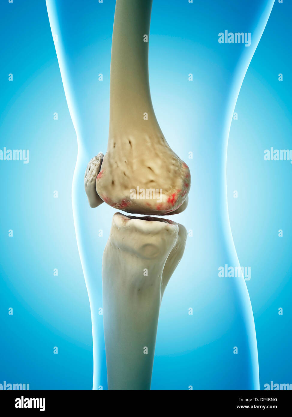 Arthritic knee hi-res stock photography and images - Alamy