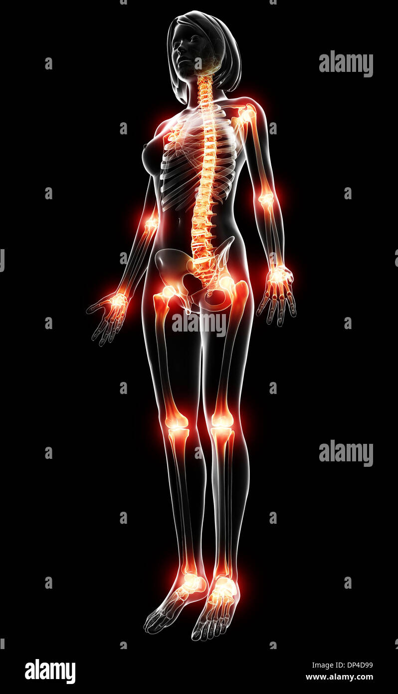 Joint pain, artwork Stock Photo - Alamy