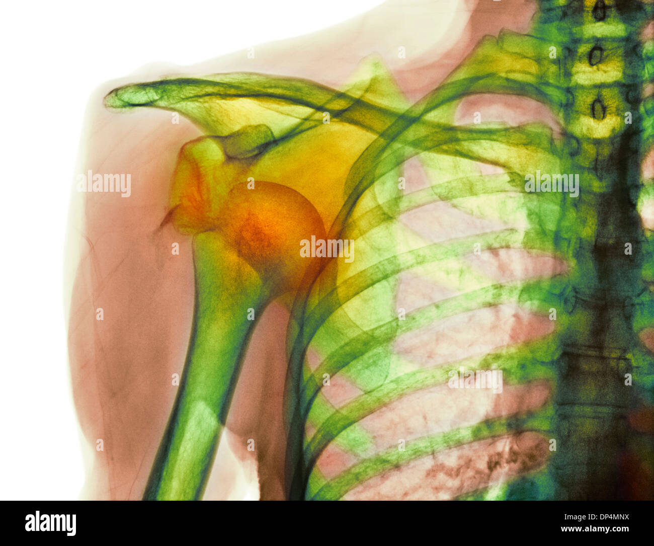 Dislocated Shoulder High Resolution Stock Photography and Images - Alamy