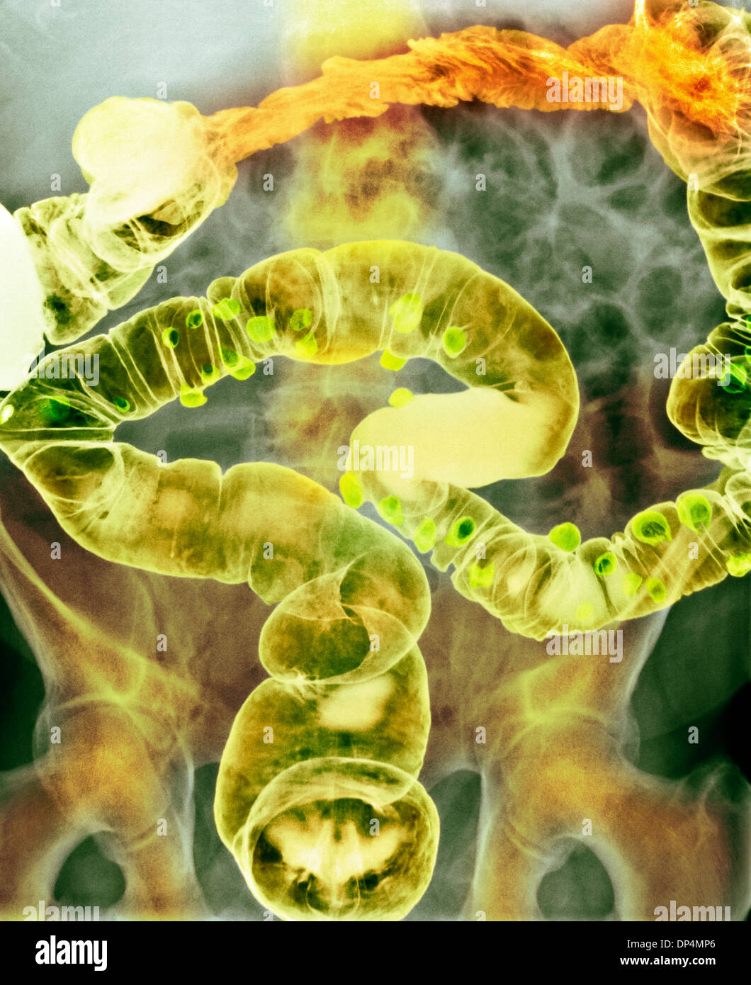 Diverticulitis hi-res stock photography and images - Alamy