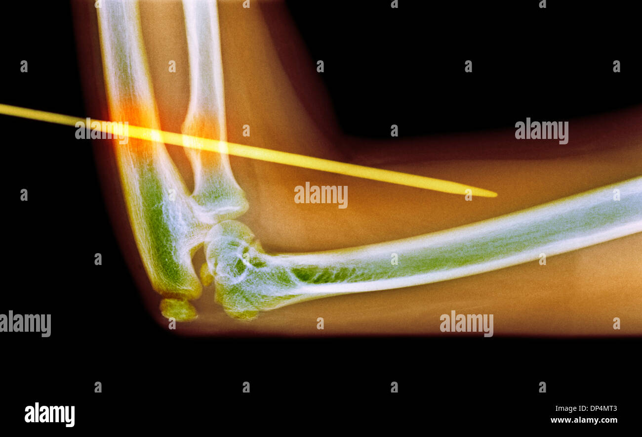 Knitting needle through arm, X-ray Stock Photo - Alamy