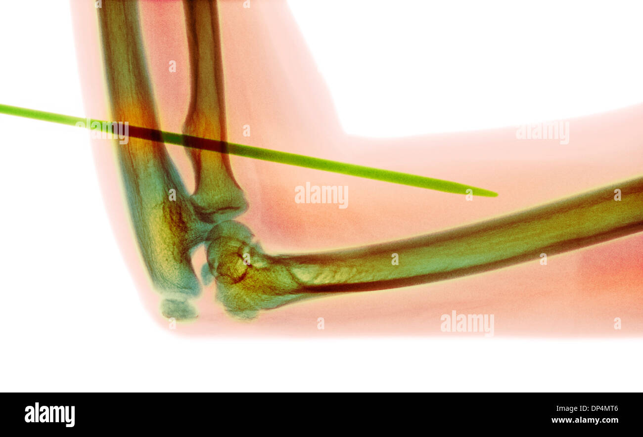 Knitting needle through arm, X-ray Stock Photo - Alamy