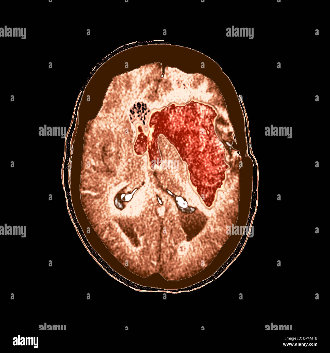 Abnormal mri brain hi-res stock photography and images - Alamy