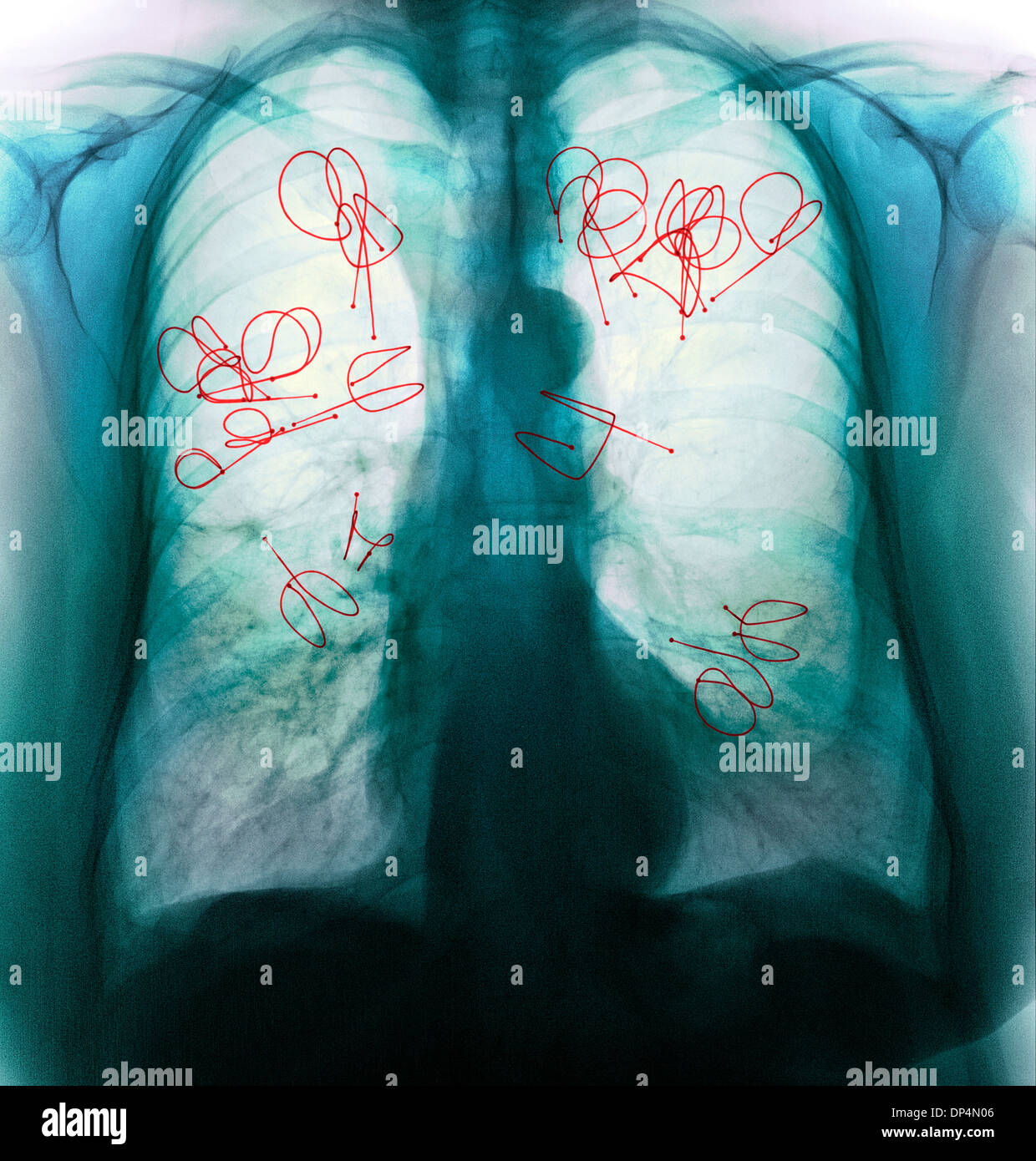 Endobronchial valves, X-ray Stock Photo - Alamy