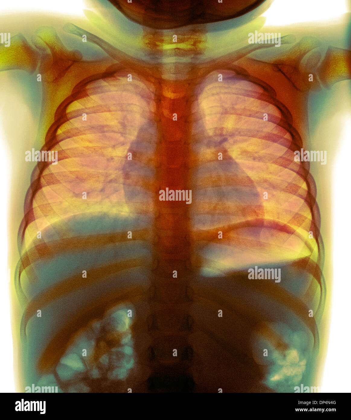 Swallowed coins, X-ray Stock Photo - Alamy