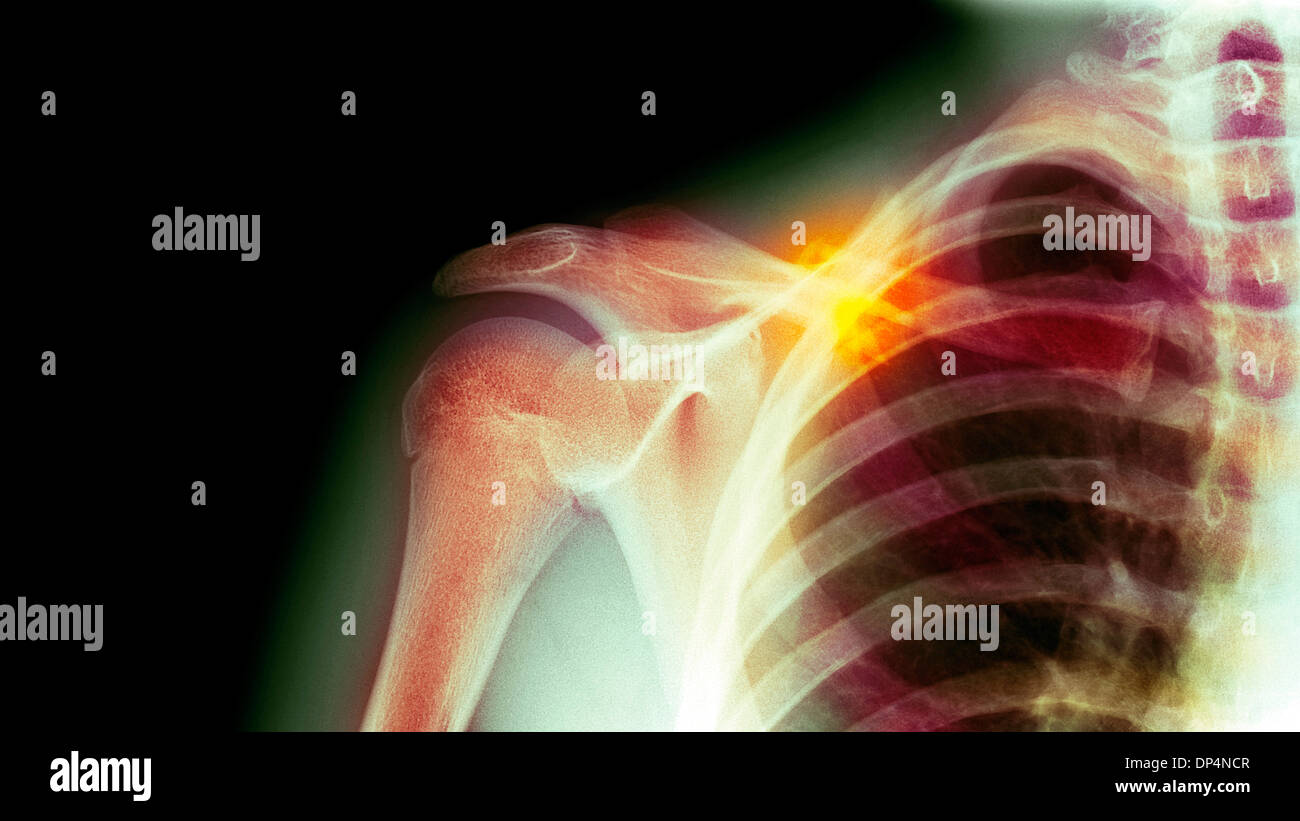 Collarbone x ray hi-res stock photography and images - Alamy