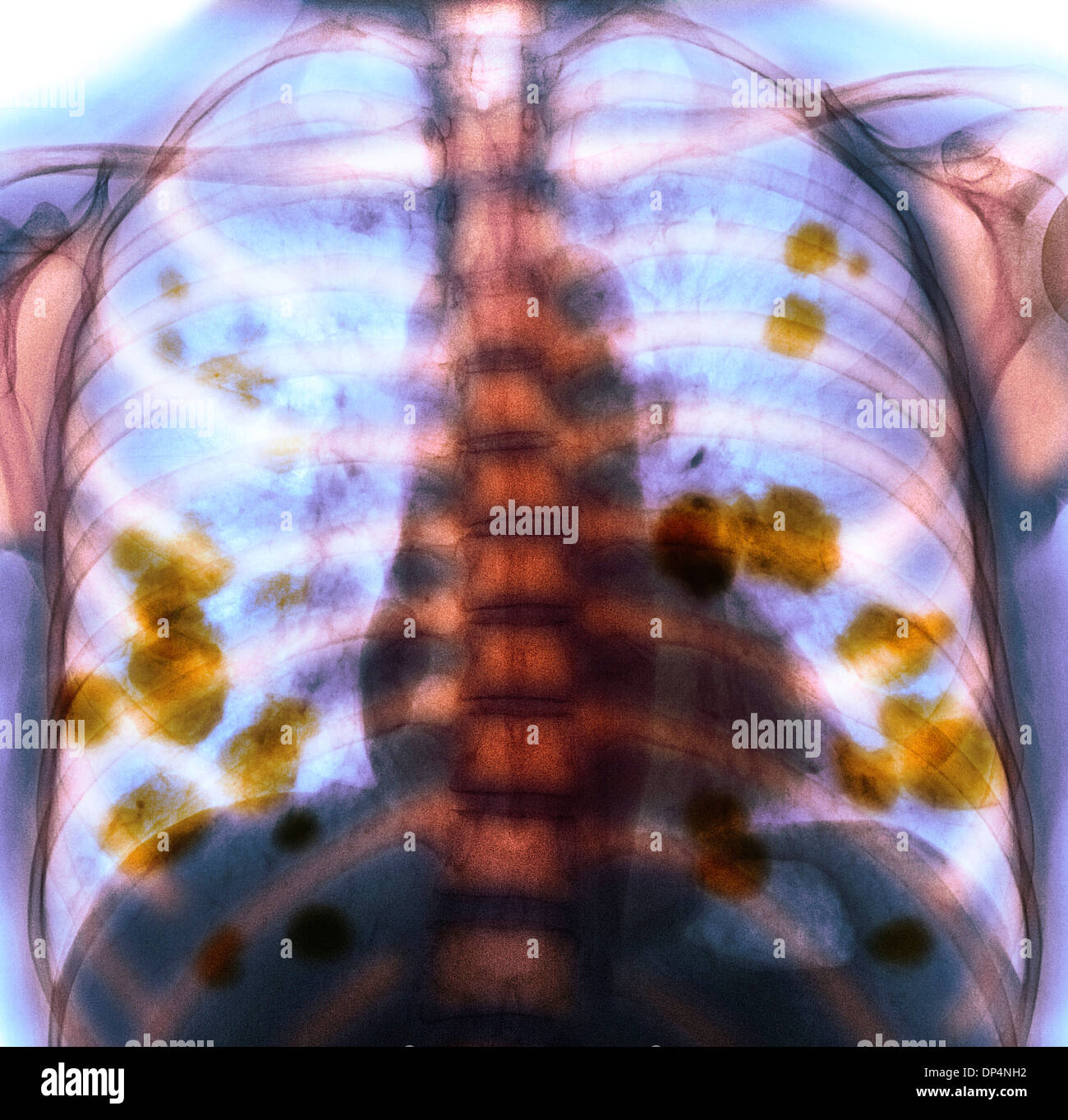 Secondary lung cancer, X-ray Stock Photo - Alamy