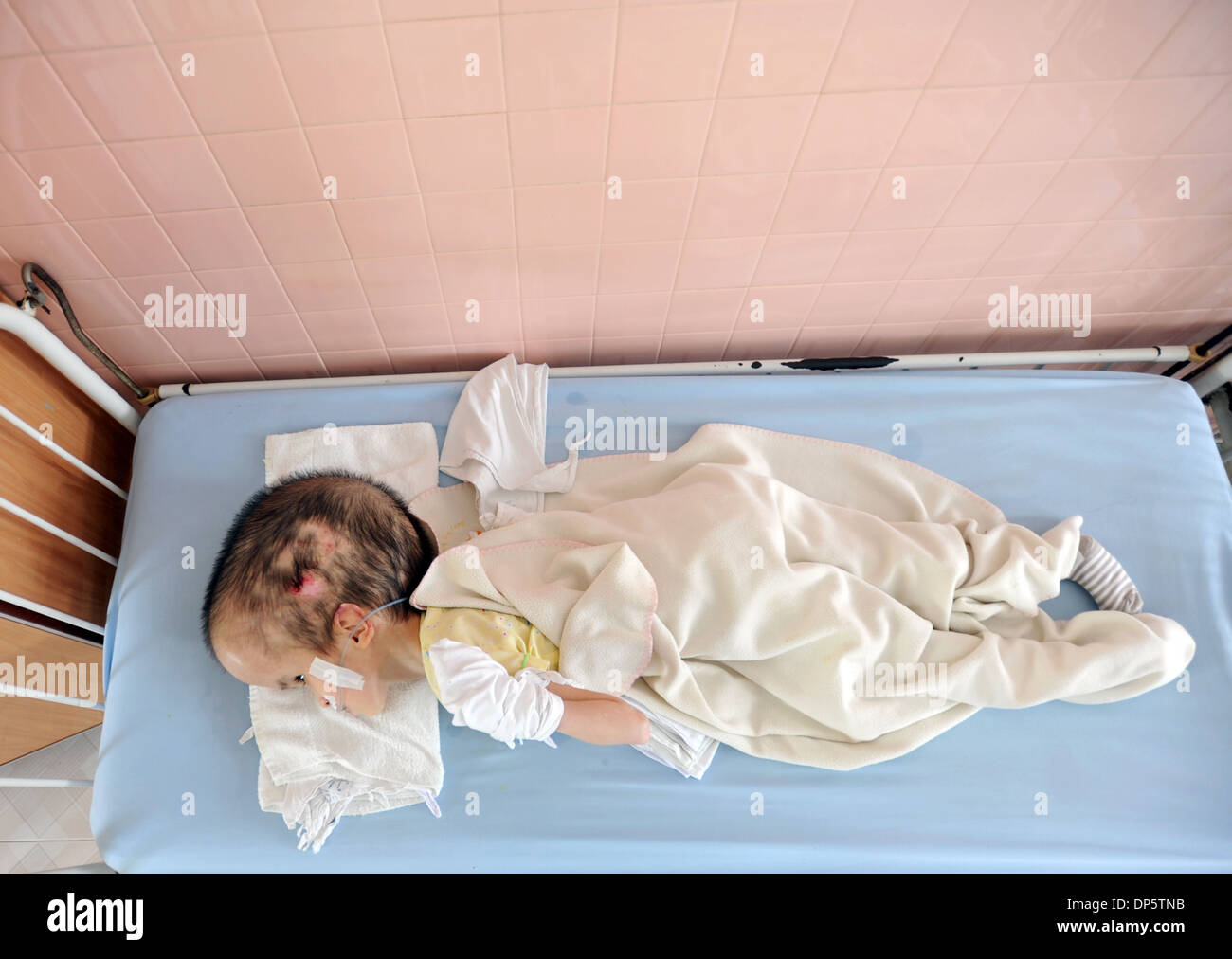 Hydrocephalus hi-res stock photography and images - Alamy