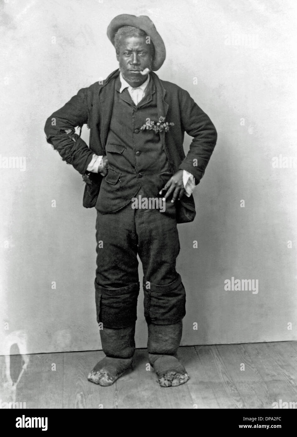Elephantiasis hi-res stock photography and images - Alamy