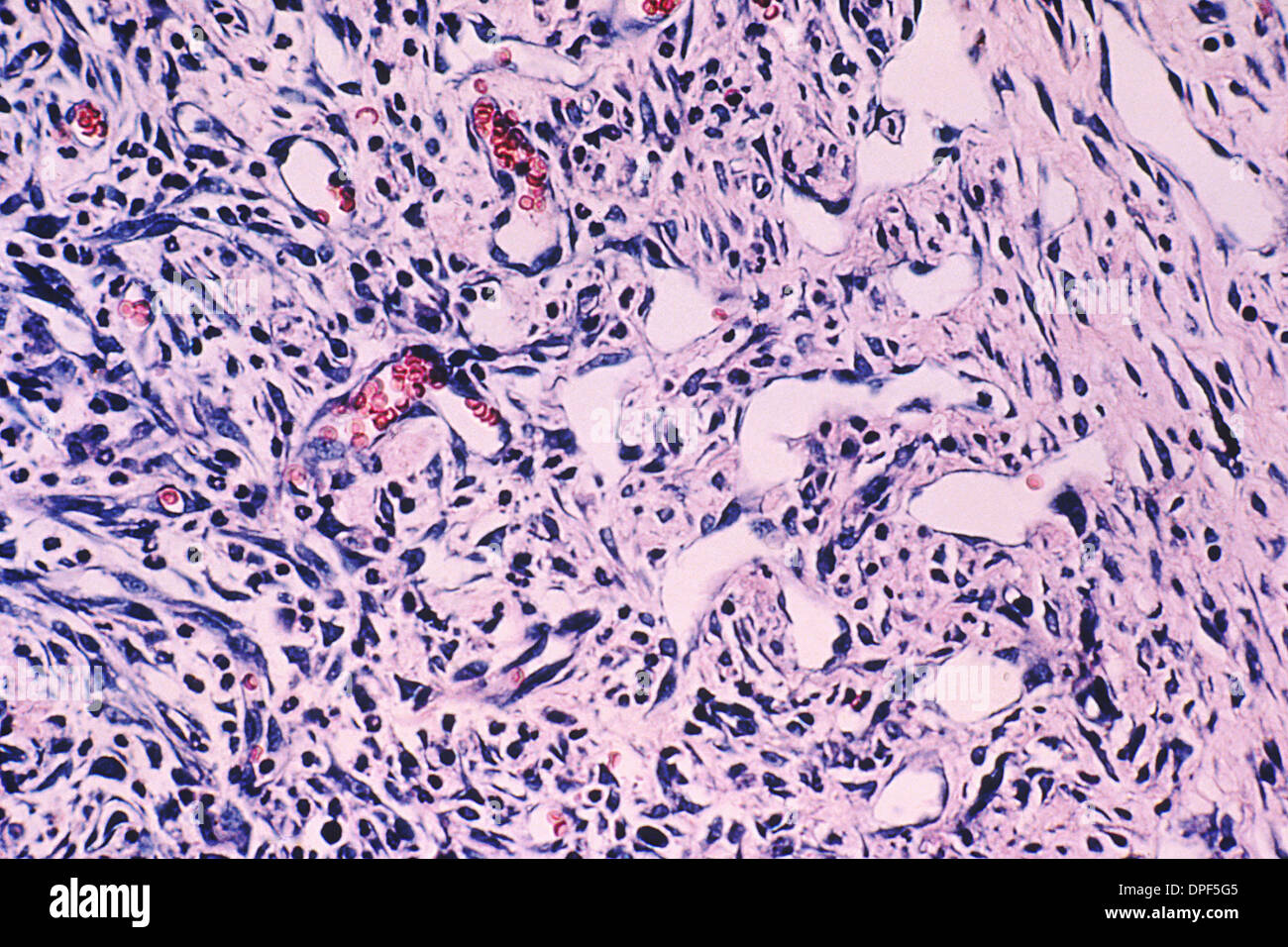 Kaposi sarcoma hi-res stock photography and images - Alamy
