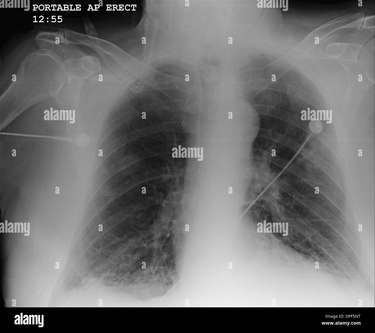 X-ray of chest showing COPD Stock Photo - Alamy