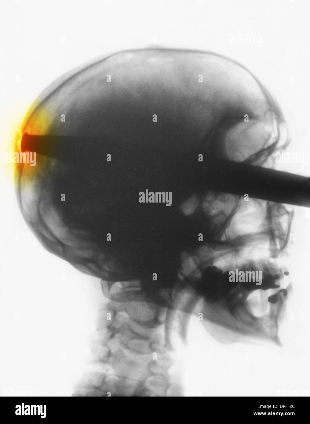X-ray of a man with a crow bar through his head Stock Photo - Alamy