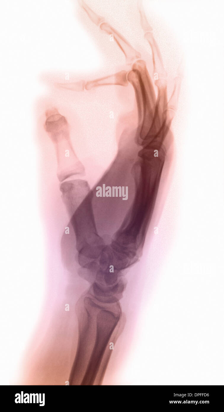 Lateral hand hi-res stock photography and images - Alamy