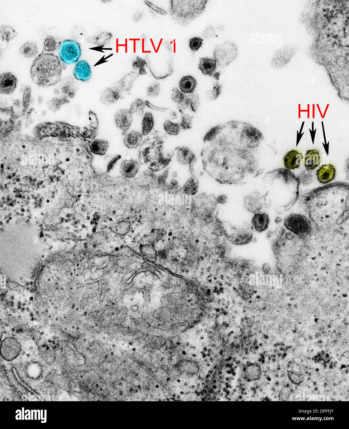 Hiv Virus Under Electron Microscope