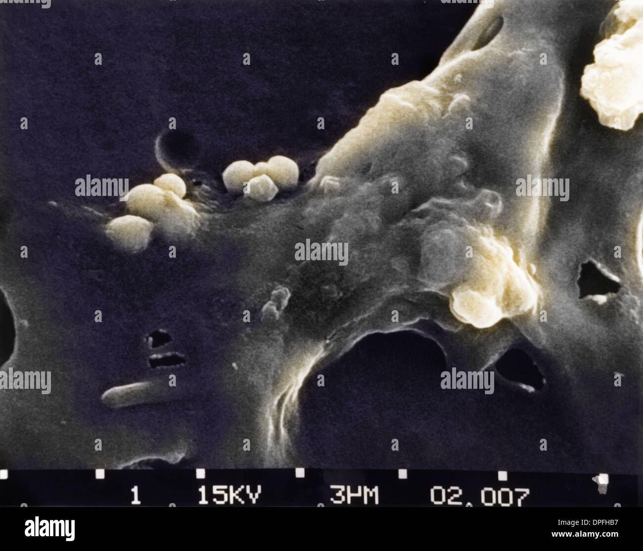 SEM of death of a Cancer Cell (6 step sequence Stock Photo - Alamy