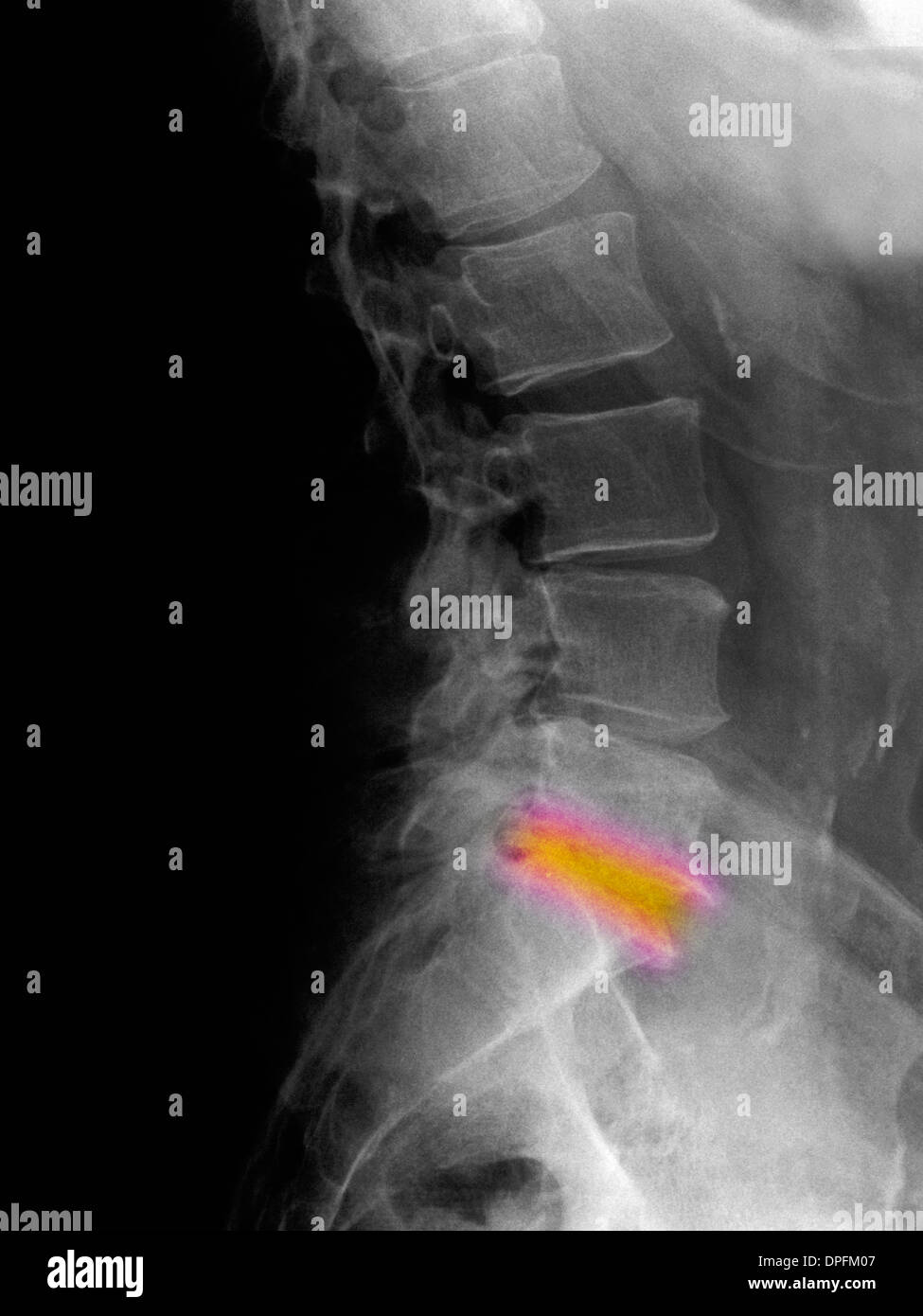Anatomy of lumbar spine hi-res stock photography and images - Alamy