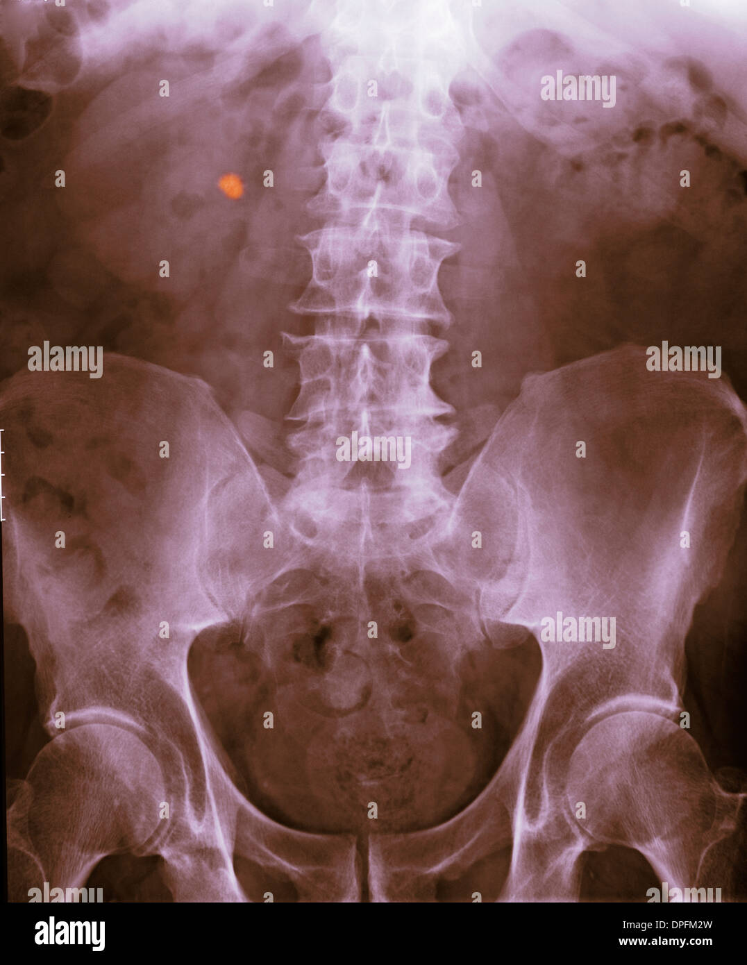 Struvite Kidney Stones Xray