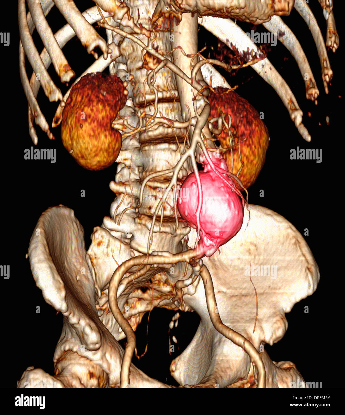 Abdominal aortic aneurysm hi-res stock photography and images - Alamy
