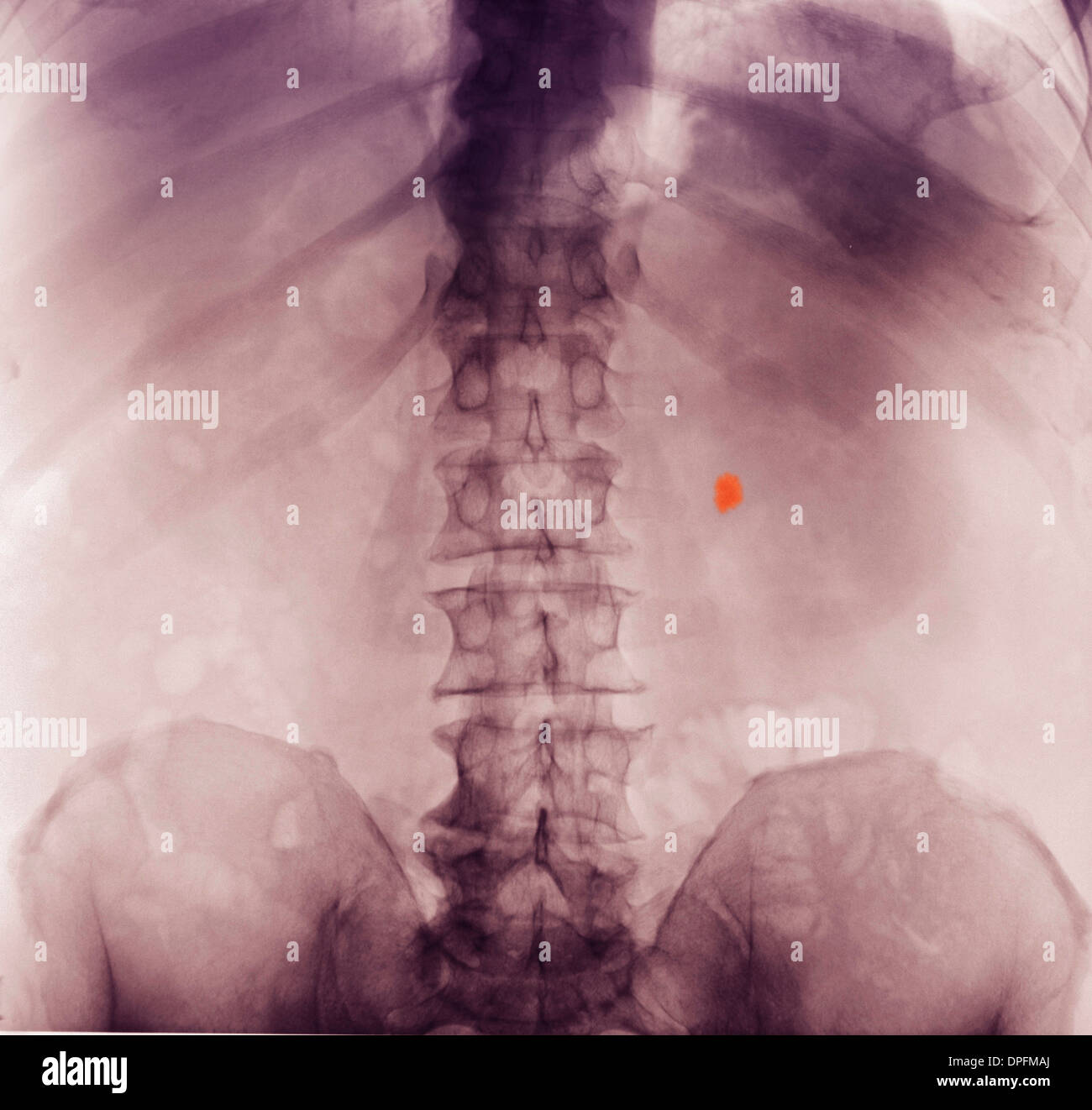 Colorized x-ray of abdomen showing a kidney stone Stock Photo - Alamy