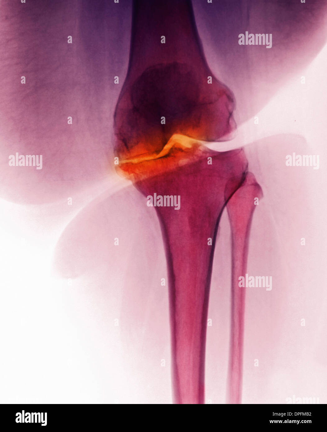 x-ray of knee showing degenerative arthritis Stock Photo - Alamy