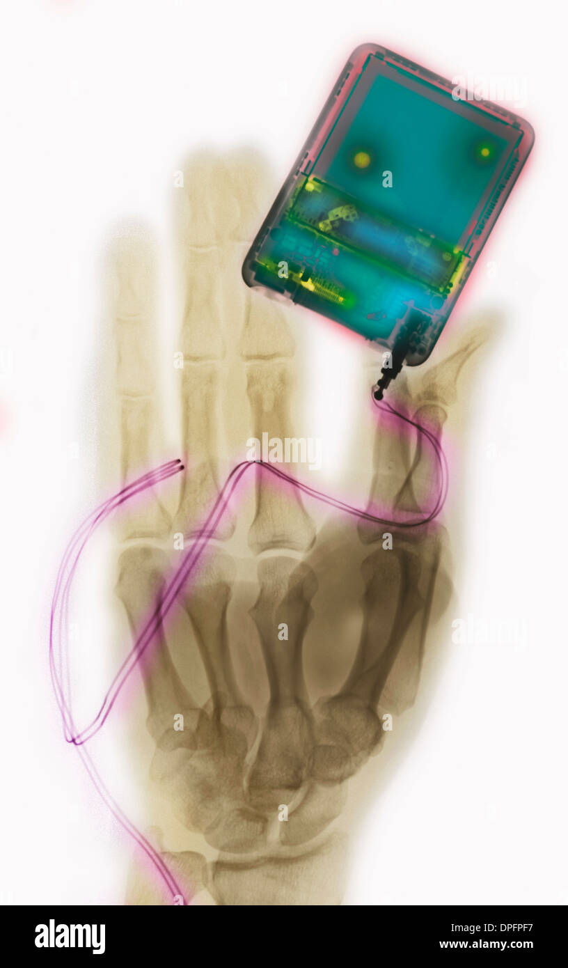 Hand x ray color hi-res stock photography and images - Alamy