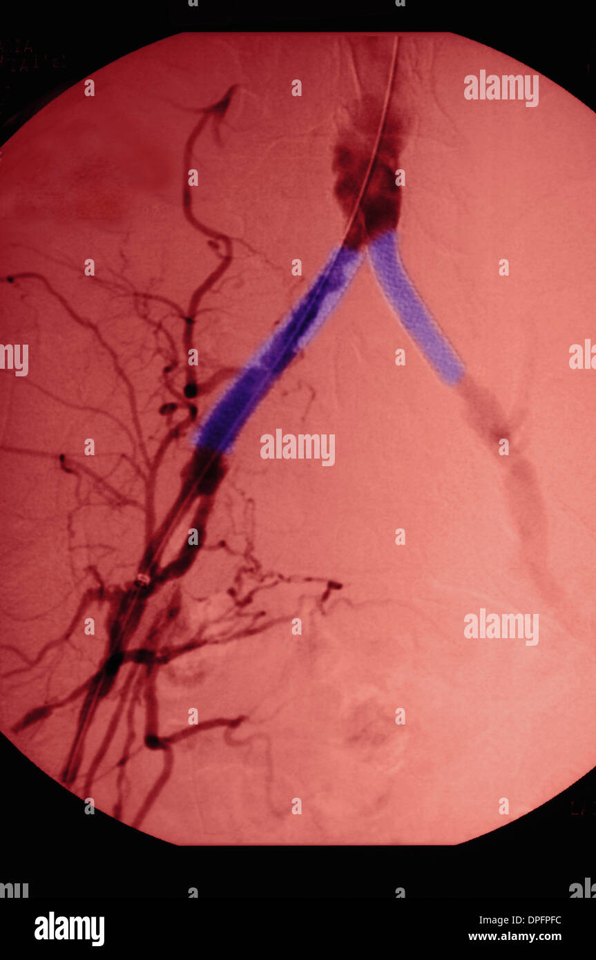 aortic angiogram with stent placement Stock Photo - Alamy