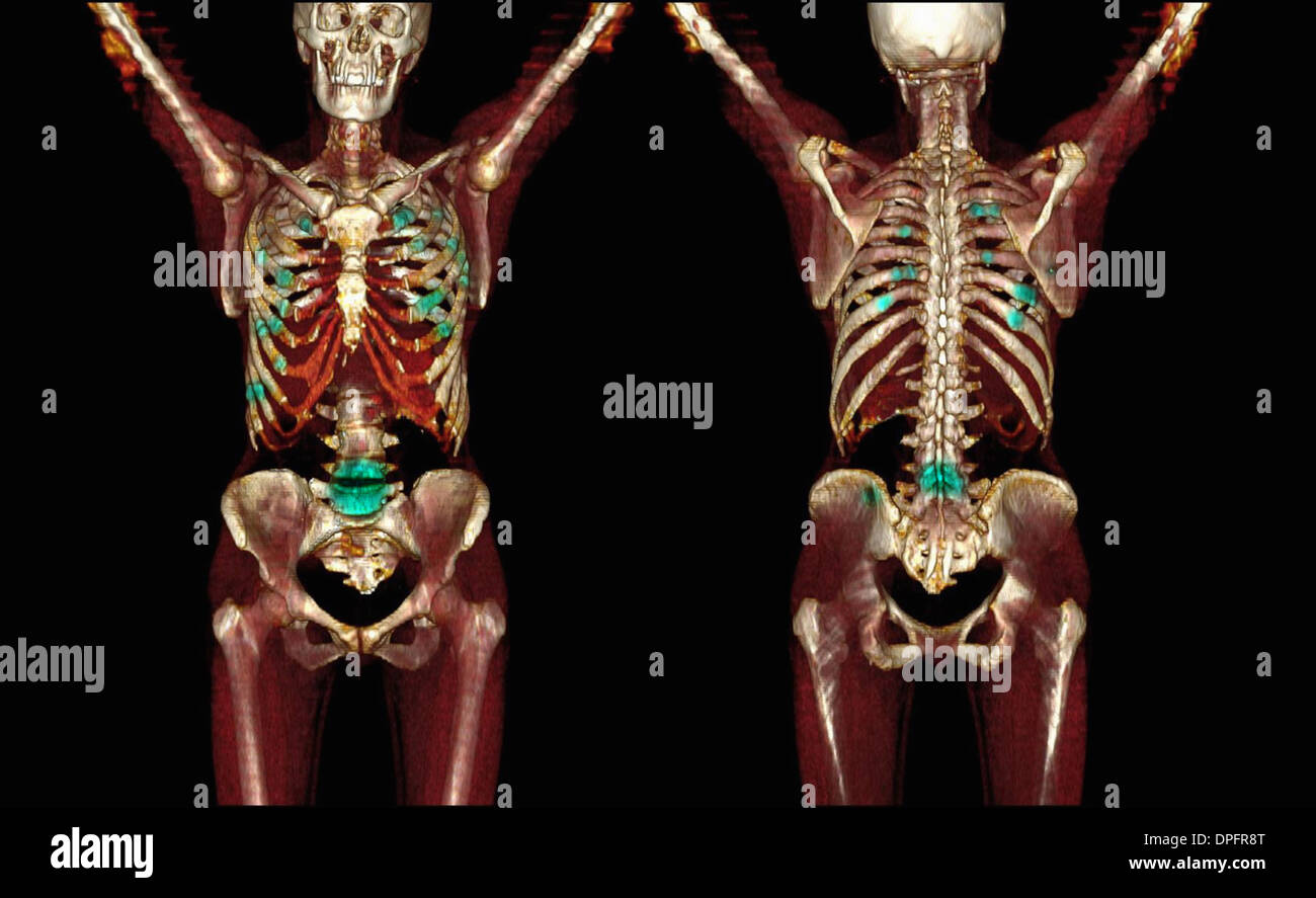 3D CT scan of metastatic bone cancer Stock Photo - Alamy